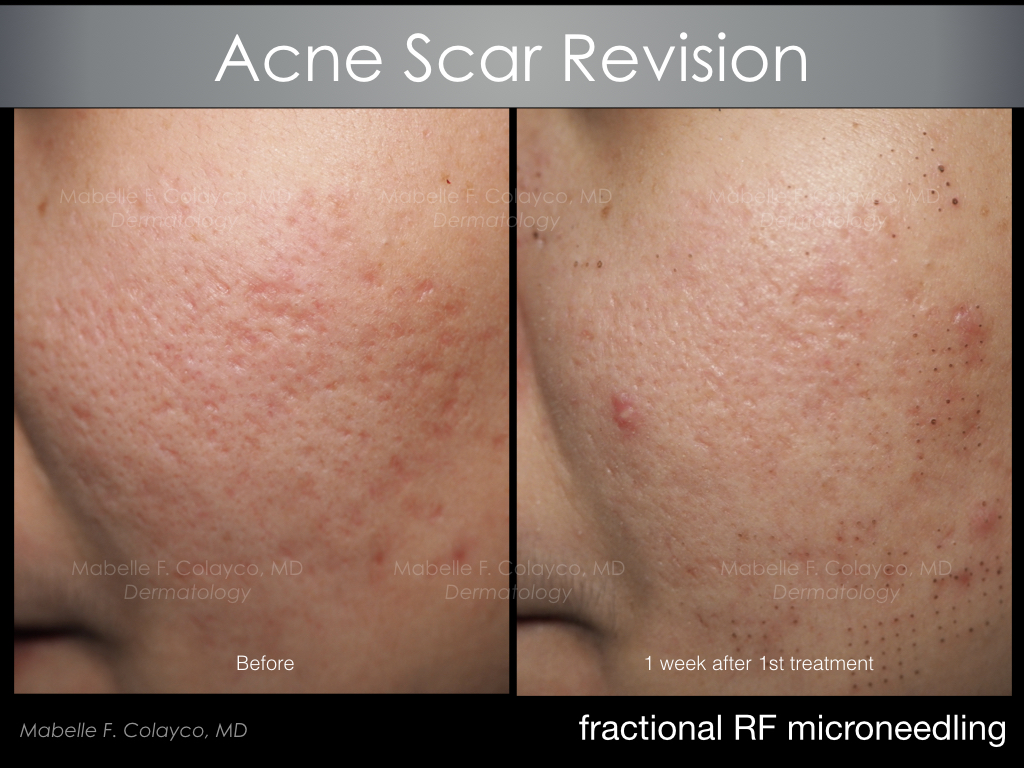 fractional RF needling – Dermalogique