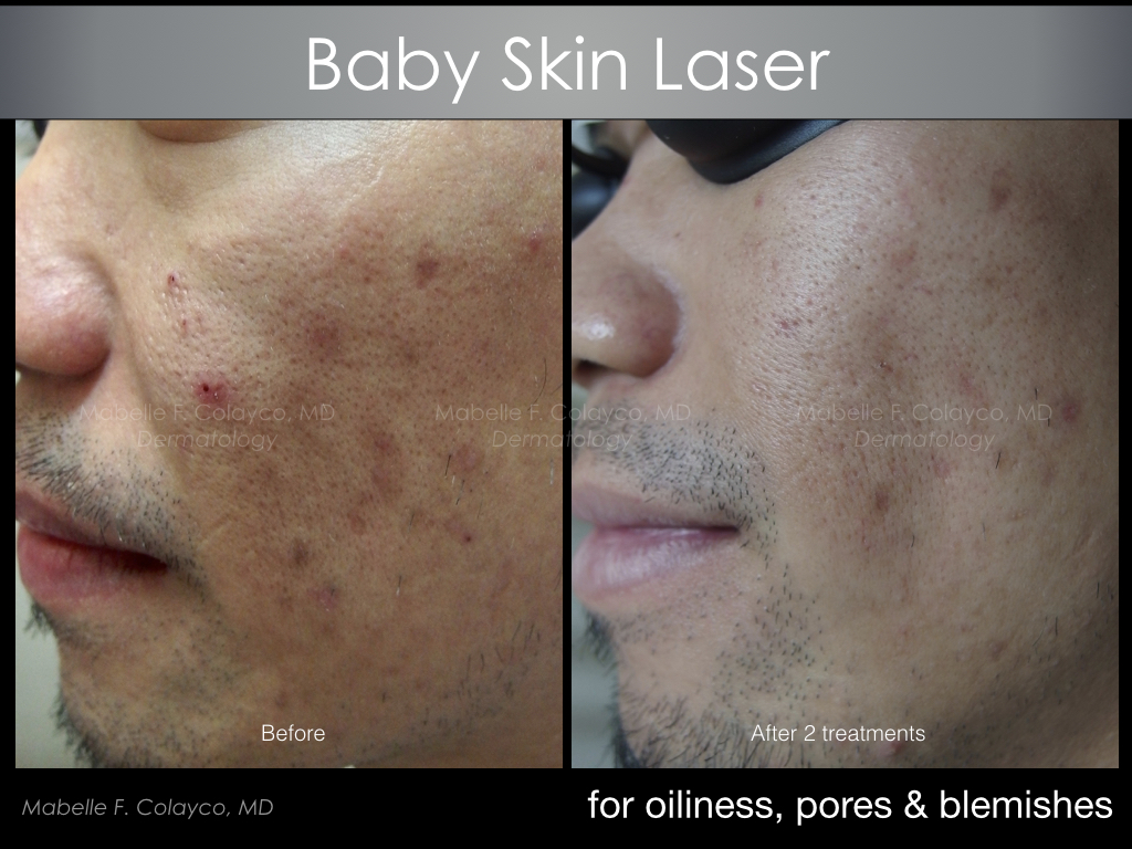 Baby skin laser – Dermalogique