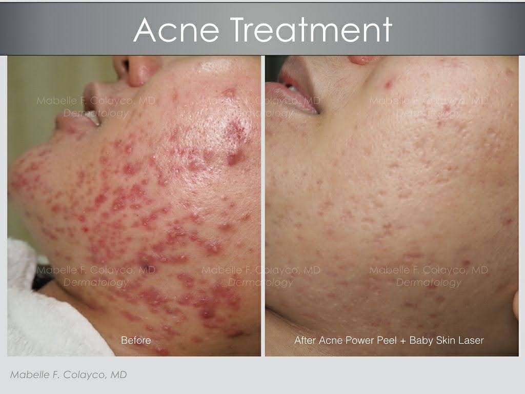 Hope for acne – Dermalogique