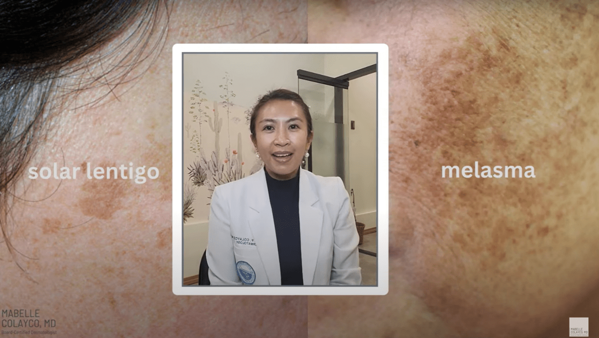 Solar lentigo vs melasma – Dermalogique